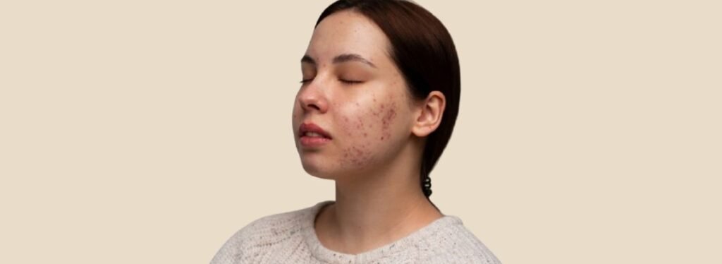 How to Treat Pitted Acne Scars and Boost Your Confidence